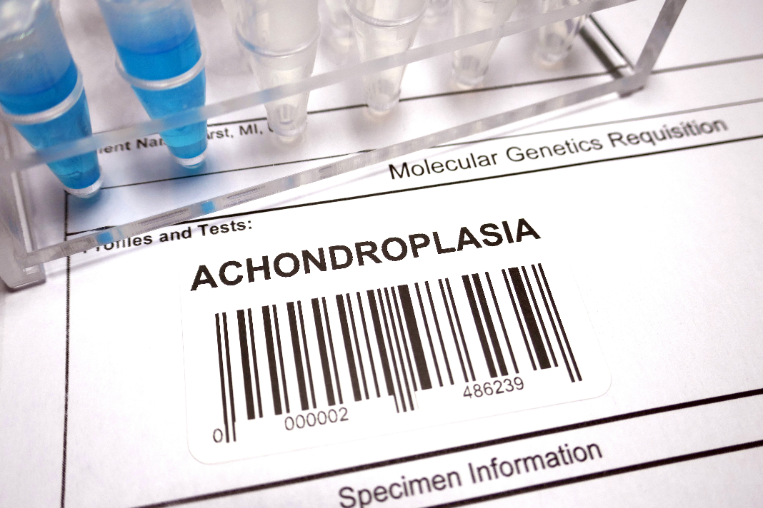Types De Nanisme Achondroplasie