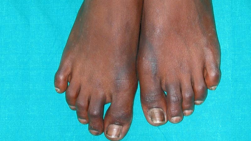 Maladie d'Addison : symptômes et causes de l'insuffisance surrénale ...