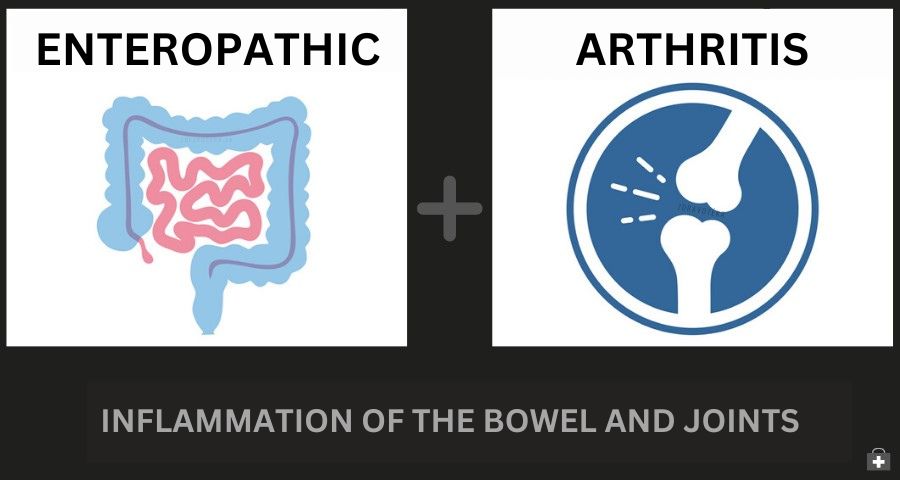 Arthrite entéropathique et maladie inflammatoire de l'intestin : quel ...